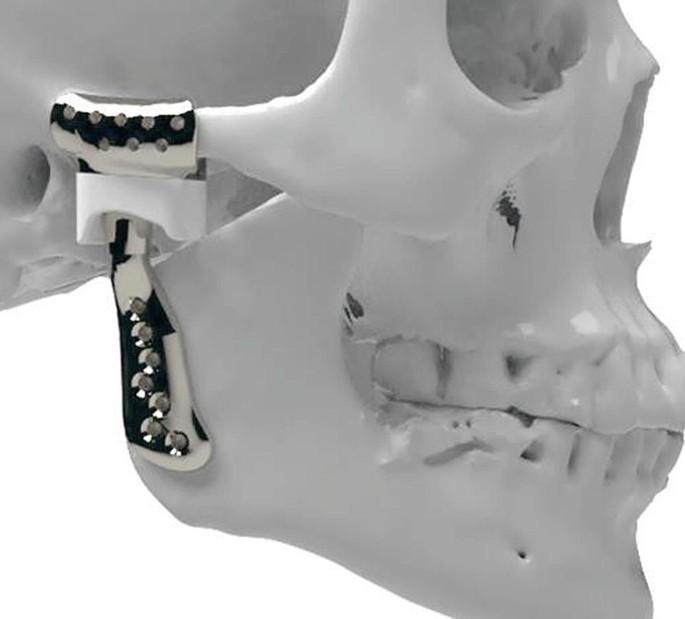 Prosthetic Reconstruction of TMJ Diseases | Springer Nature Link