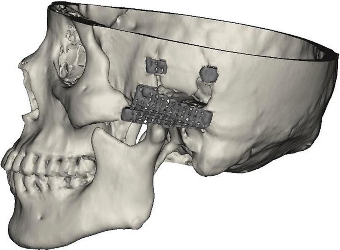 Reconstruction of Skull Base-Fossa Diseases, While Preserving the TMJ ...