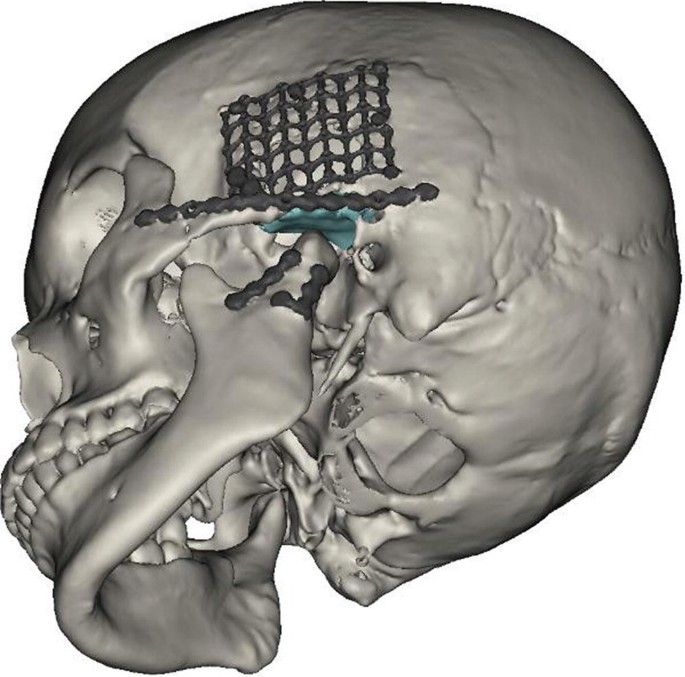 Reconstruction of Skull Base-Fossa Diseases, While Preserving the TMJ ...