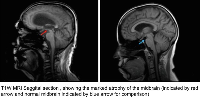 Elderly Male with Difficulty in Swallowing, Unsteadiness of Gait, and ...