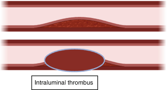 Post-coital Headache: Not Tonight, John | SpringerLink