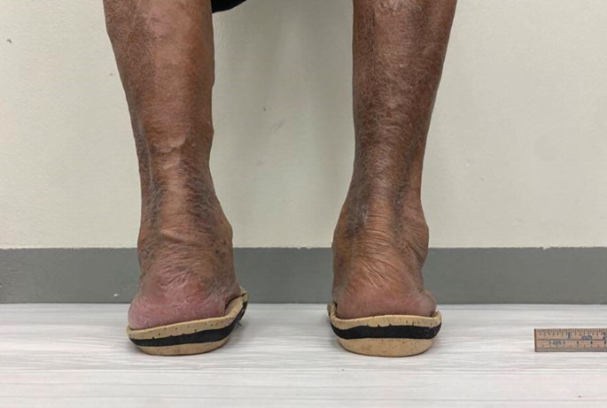 Design and Material Considerations for Insoles | SpringerLink