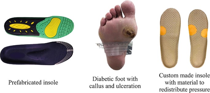 Clinical Evaluation and Prescription of Insoles | Springer Nature Link