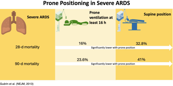 Prone Ventilation in Acute Respiratory Distress Syndrome: The PROSEVA ...