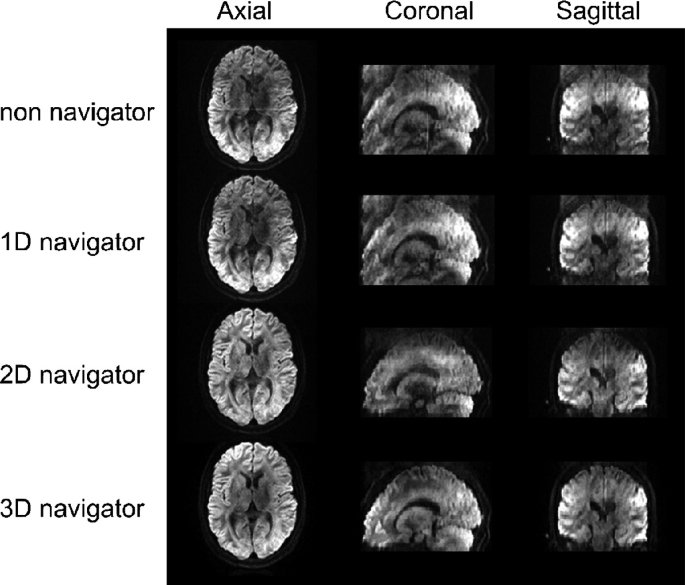 3D Navigator based 3D Gradient Spin Echo Imaging | SpringerLink