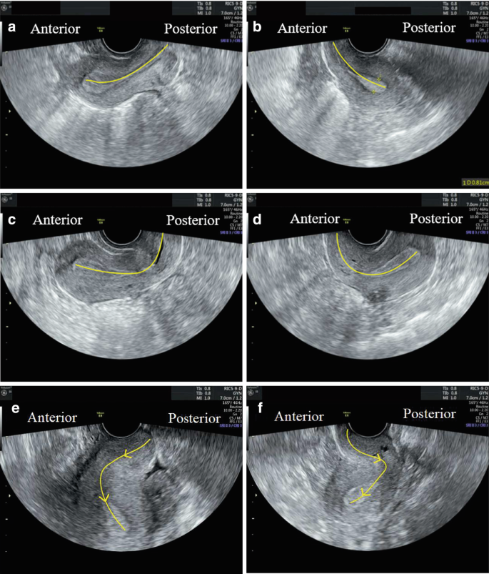 Standardized Protocol for Transvaginal Ultrasound of the Uterus and ...