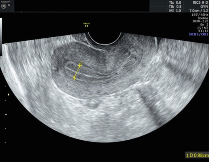Standardized Protocol for Transvaginal Ultrasound of the Uterus and ...