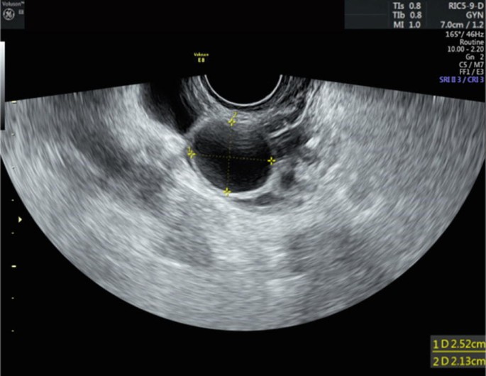 Standardized Protocol for Transvaginal Ultrasound of the Uterus and ...
