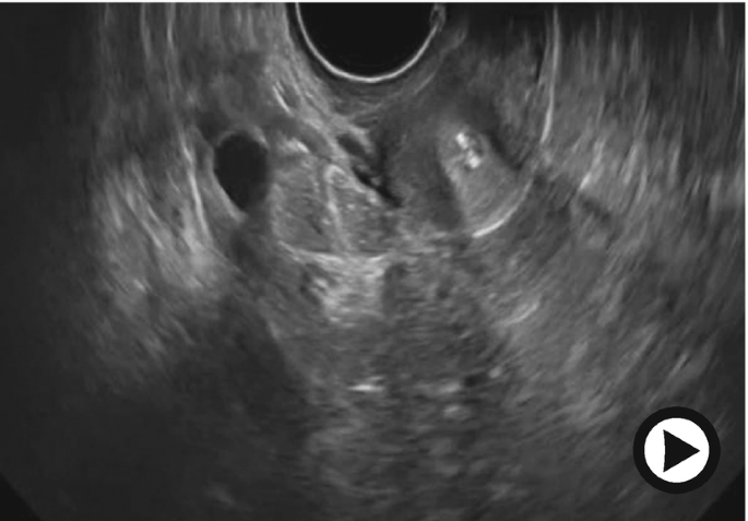 Assessment of Tubal Patency by Ultrasound | Springer Nature Link