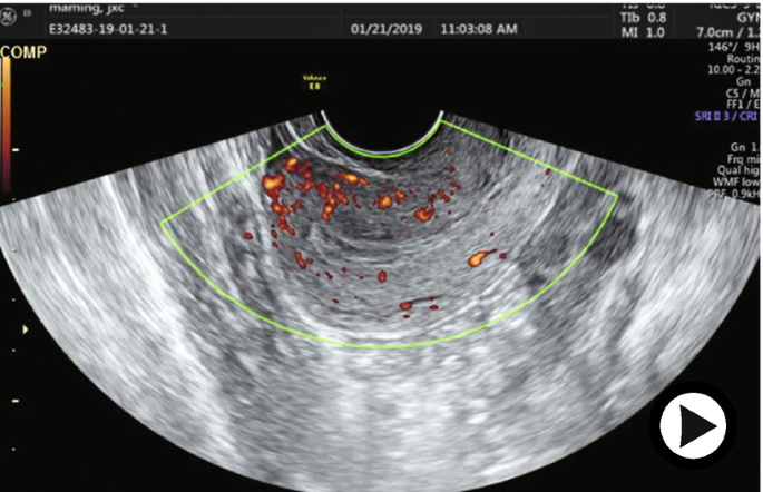 Ultrasound Assessment of Endometrial Receptivity | Springer Nature Link