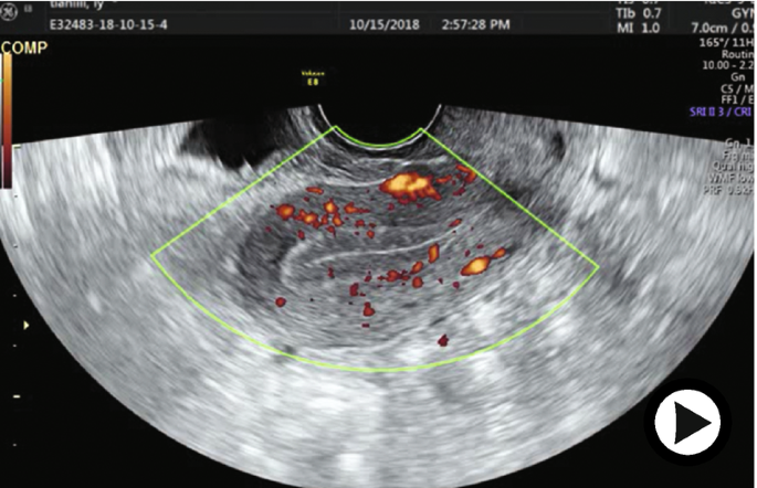 Ultrasound Assessment of Endometrial Receptivity | Springer Nature Link