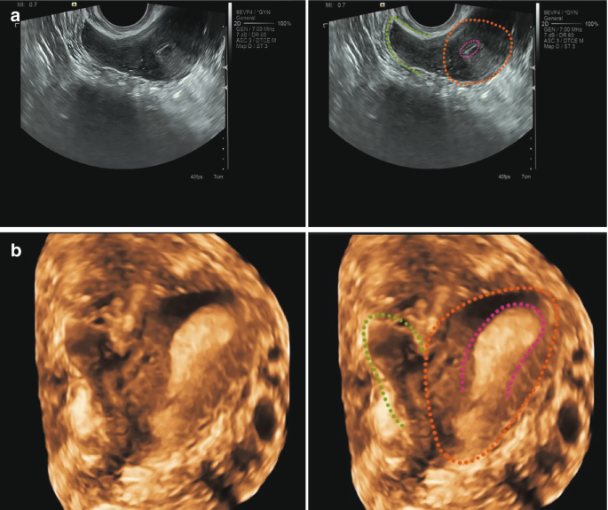 Ultrasound Evaluation of Reproduction-Related Gynecologic Conditions ...