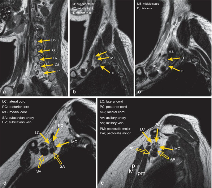 Brachial Plexus Disorders | Springer Nature Link