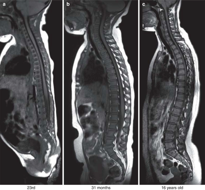 Development of Normal Pediatric Spine and Congenital Spinal and Spinal ...