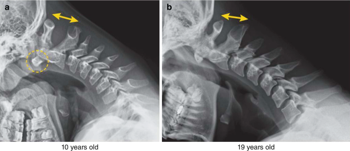 Development of Normal Pediatric Spine and Congenital Spinal and Spinal ...
