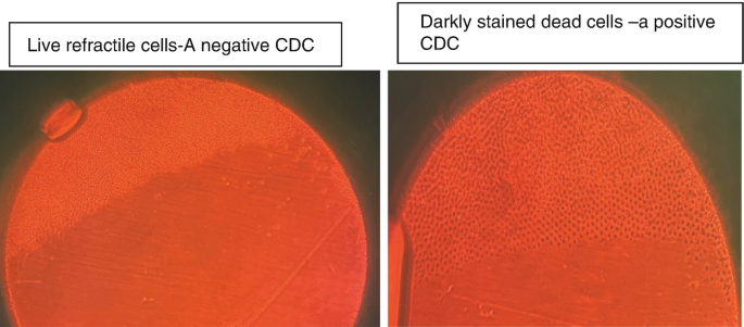 A Persistent CDC Positive Cross-Match in a Patient Awaiting Transplant ...