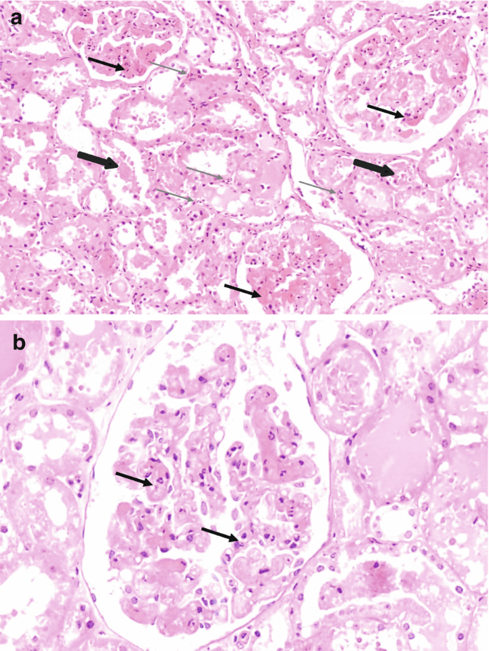 Kidney Transplant Rejection: T-Cell and Antibody-Mediated Rejection ...