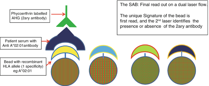 A Case Based Approach to the Sensitized Recipient with DSA on the SAB ...