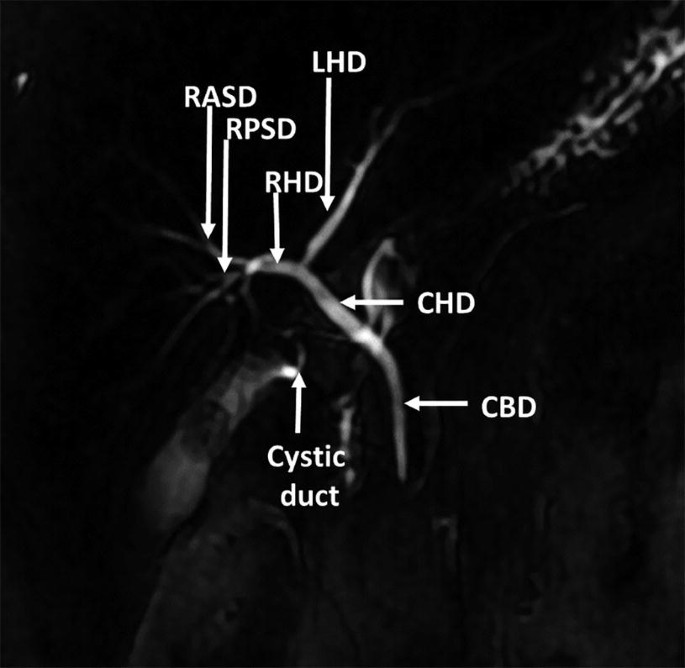 Anatomic Variations in the Biliary and Vascular Anatomy of the Liver ...