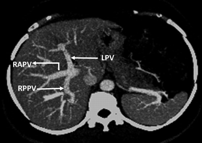 Anatomic Variations in the Biliary and Vascular Anatomy of the Liver ...