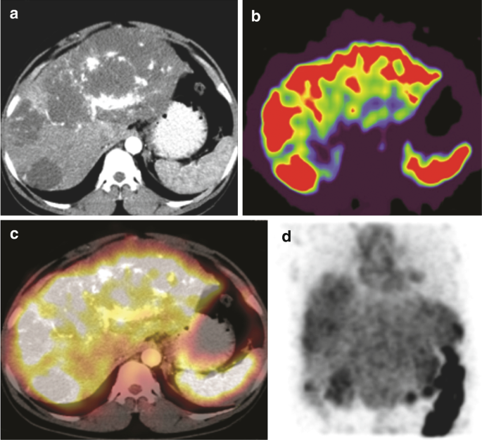 PET/CT in Hepatobiliary Pancreatic Tumours | Springer Nature Link