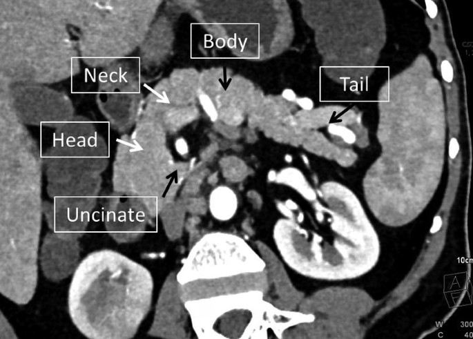 Normal Anatomy and Anatomic Variations of the Pancreas | Springer ...