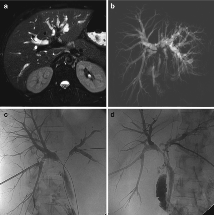 Interventional Radiology in the Biliary Tree, Liver, and Pancreas ...
