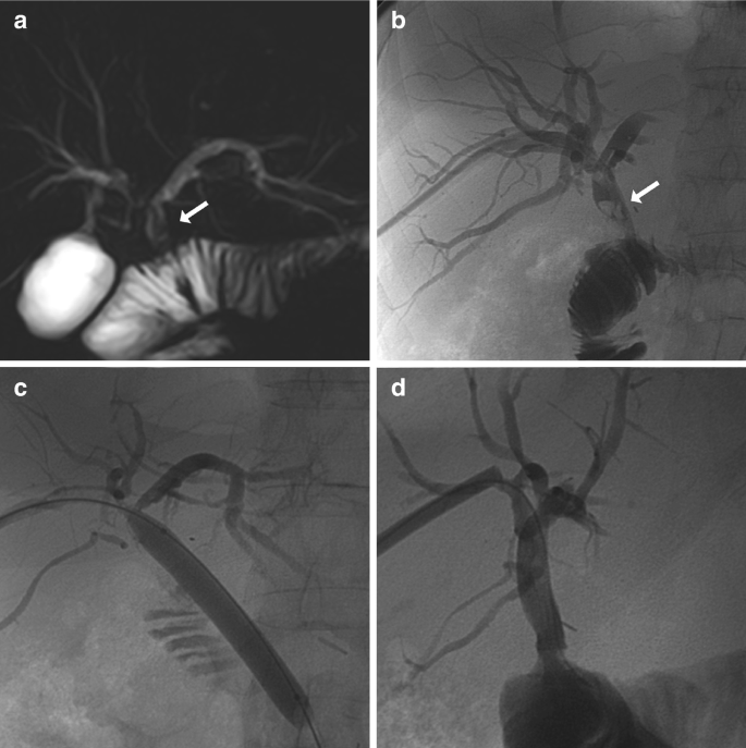 Interventional Radiology in the Biliary Tree, Liver, and Pancreas ...
