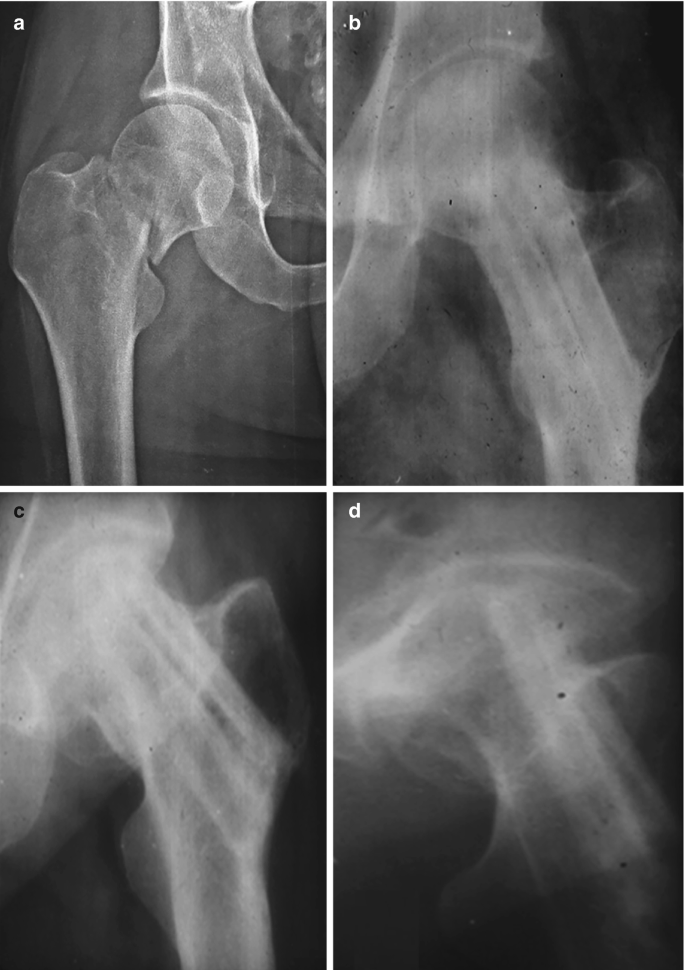 Twin NVFG Used for Fixation of Early Femoral Neck Fractures | SpringerLink
