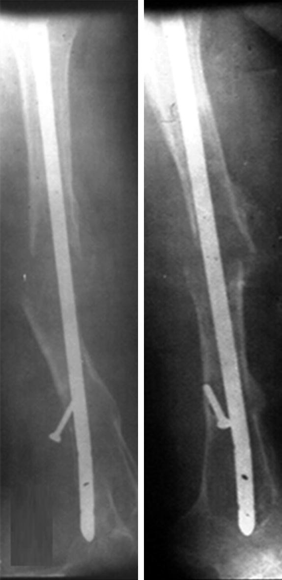 ‘The Biological IM Nail’: Bone-in-Bone Fixation with Osteogenic ...