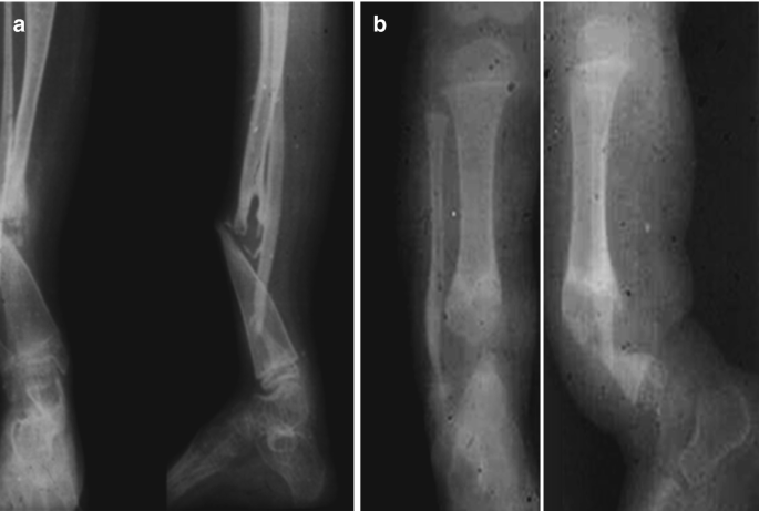 Bilateral Congenital Pseudarthroses of the Tibiae | Springer Nature Link