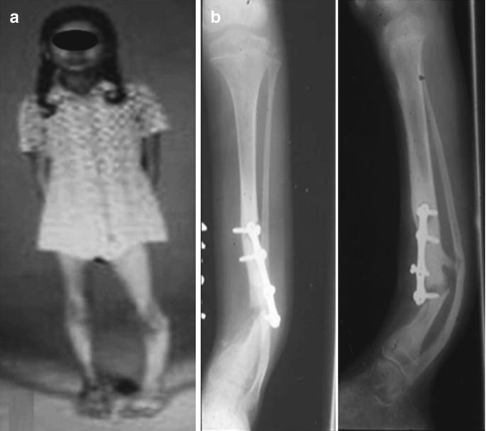 Bilateral Congenital Pseudarthroses of the Tibiae | Springer Nature Link