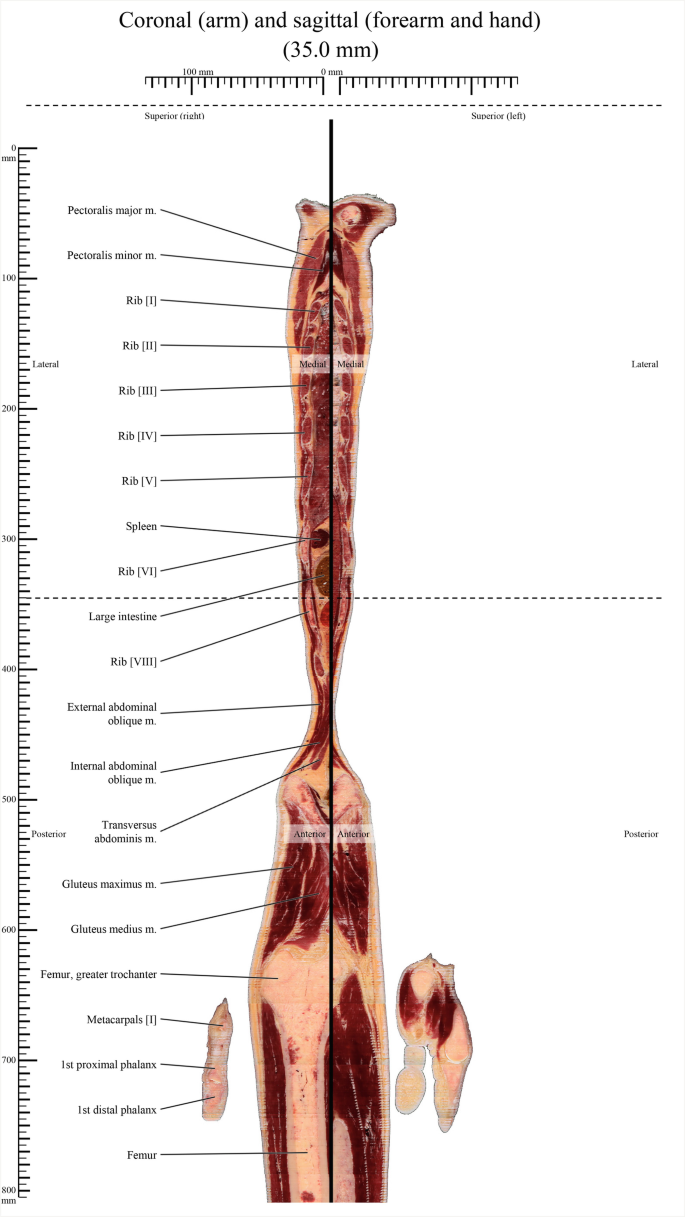 Coronal (Arm) and Sagittal (Forearm and Hand) Planes of Upper Limbs ...
