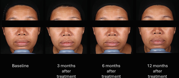 Injectable Biostimulators in Regenerative Aesthetics: Mechanisms ...
