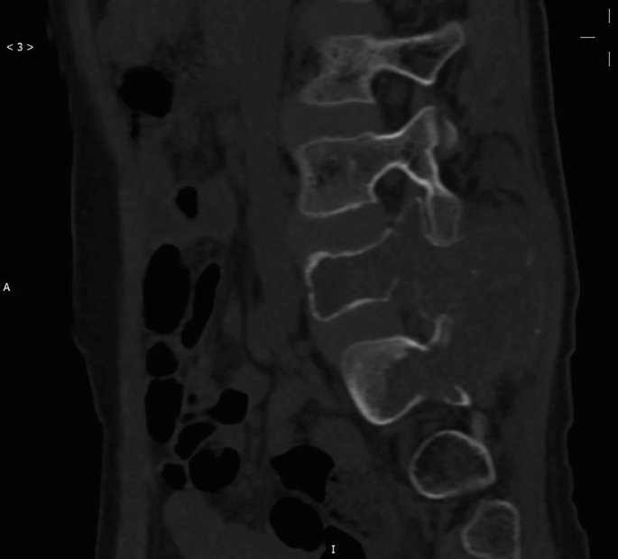 Aneurysmal Bone Cyst: Case 23 | Springer Nature Link