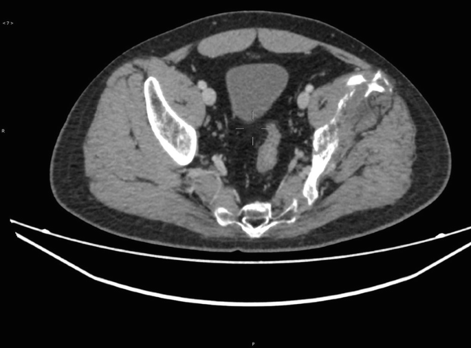 Gorham-Stout Disease: Case 33 | Springer Nature Link