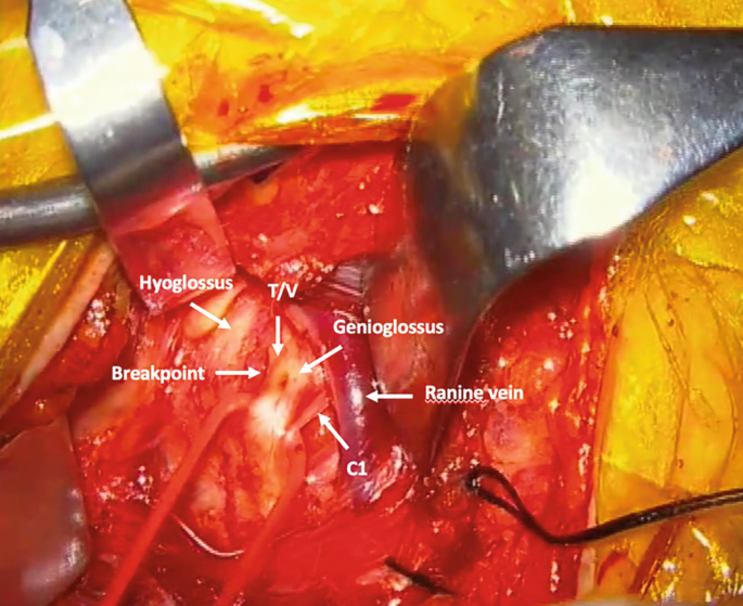 Hypoglossal Nerve Stimulation Implant | Springer Nature Link