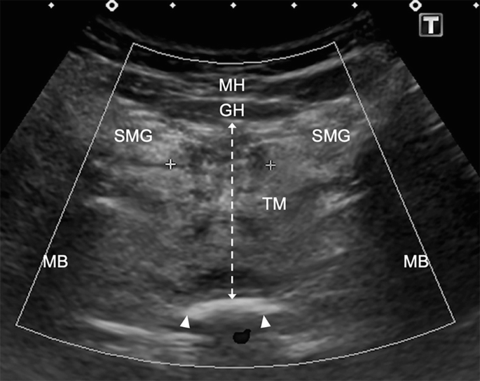 Application of Ultrasound in Obstructive Sleep Apnea Management ...
