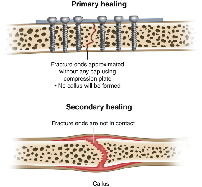 Fracture Healing | Springer Nature Link (formerly SpringerLink)