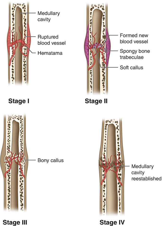 Fracture Healing | Springer Nature Link (formerly SpringerLink)