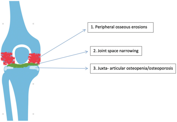 Tuberculosis of Knee and Other Joints | Springer Nature Link