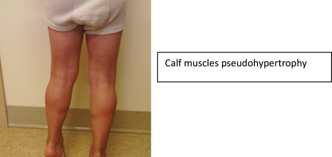Muscle Dystrophies and Myopathies | Springer Nature Link