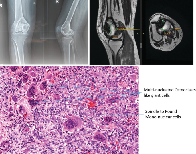 Classification of Bone Tumors | Springer Nature Link