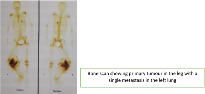 Classification of Bone Tumors | Springer Nature Link