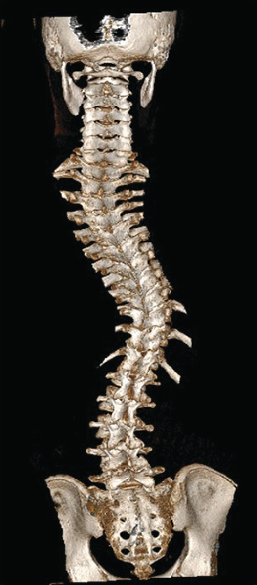 Scoliosis and Kyphosis | Springer Nature Link