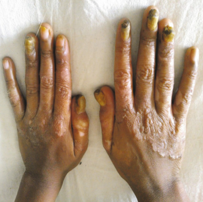 A 12-Year-Old Boy with Recurrent Carpopedal Spasm | SpringerLink