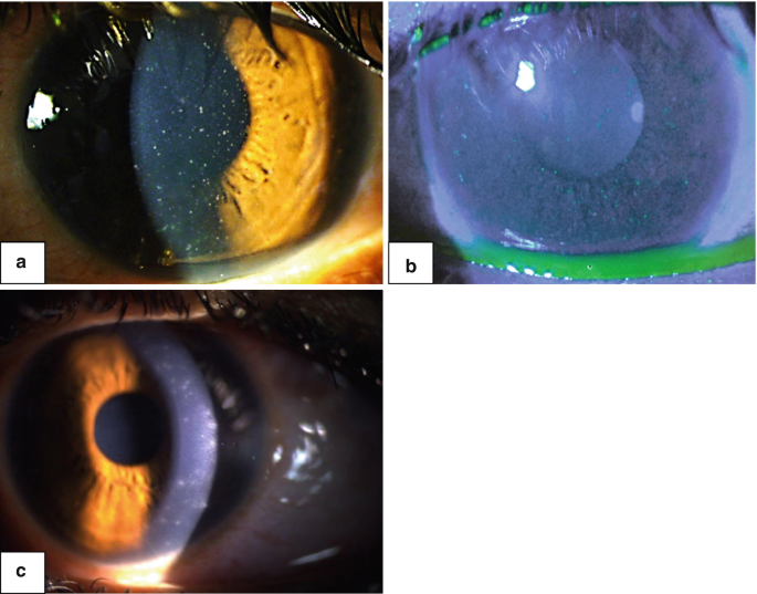 Management of Adenoviral Keratoconjunctivitis | Springer Nature Link ...
