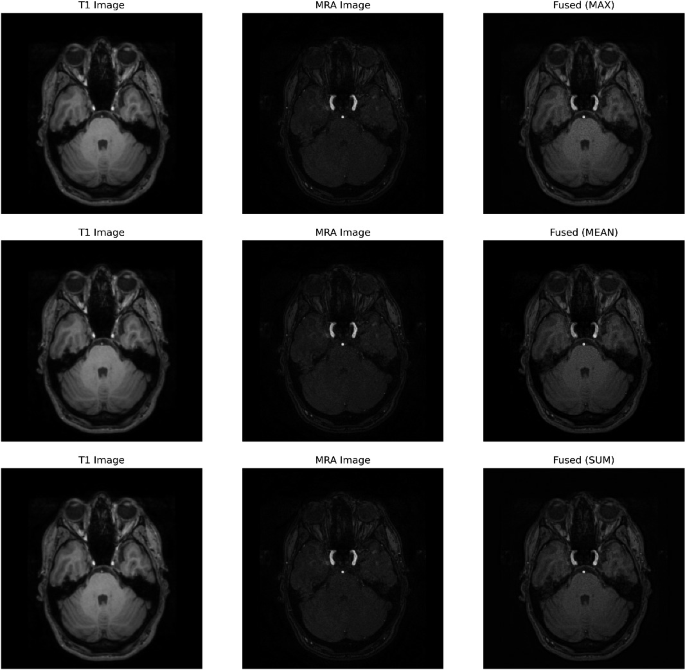 Stroke Locus Net: Occluded Vessel Localization from MRI Modalities ...