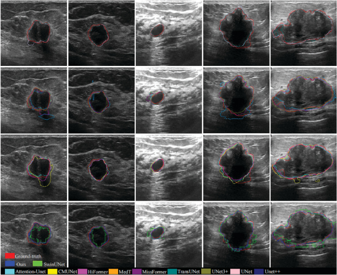 $$\text {E}^{2}\text {D}^{2}$$ R-Net: Echo-Enhanced Dual-Dilated ...