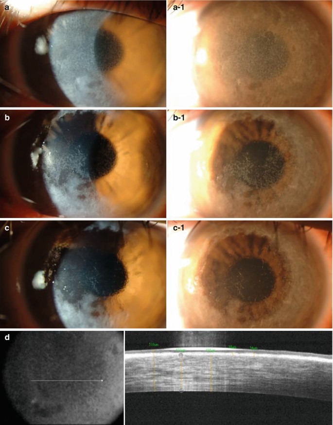 TGFBI Corneal Dystrophies: Reis—Bücklers Corneal Dystrophy (RBCD ...